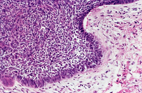 Carcinome basocellulaire Photos Science Photo Library