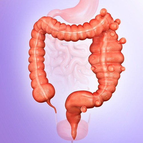 Divertikulose Bilder Science Photo Library