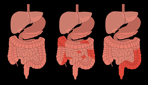 Morbus Crohn Bilder Science Photo Library