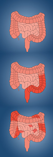 Morbus Crohn Bilder Science Photo Library