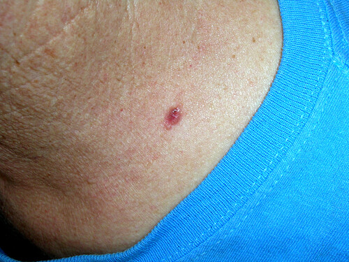 Carcinome basocellulaire Photos Science Photo Library