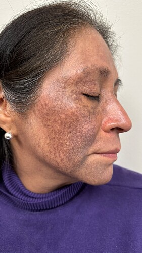 Lichen ruber planus Bilder Science Photo Library